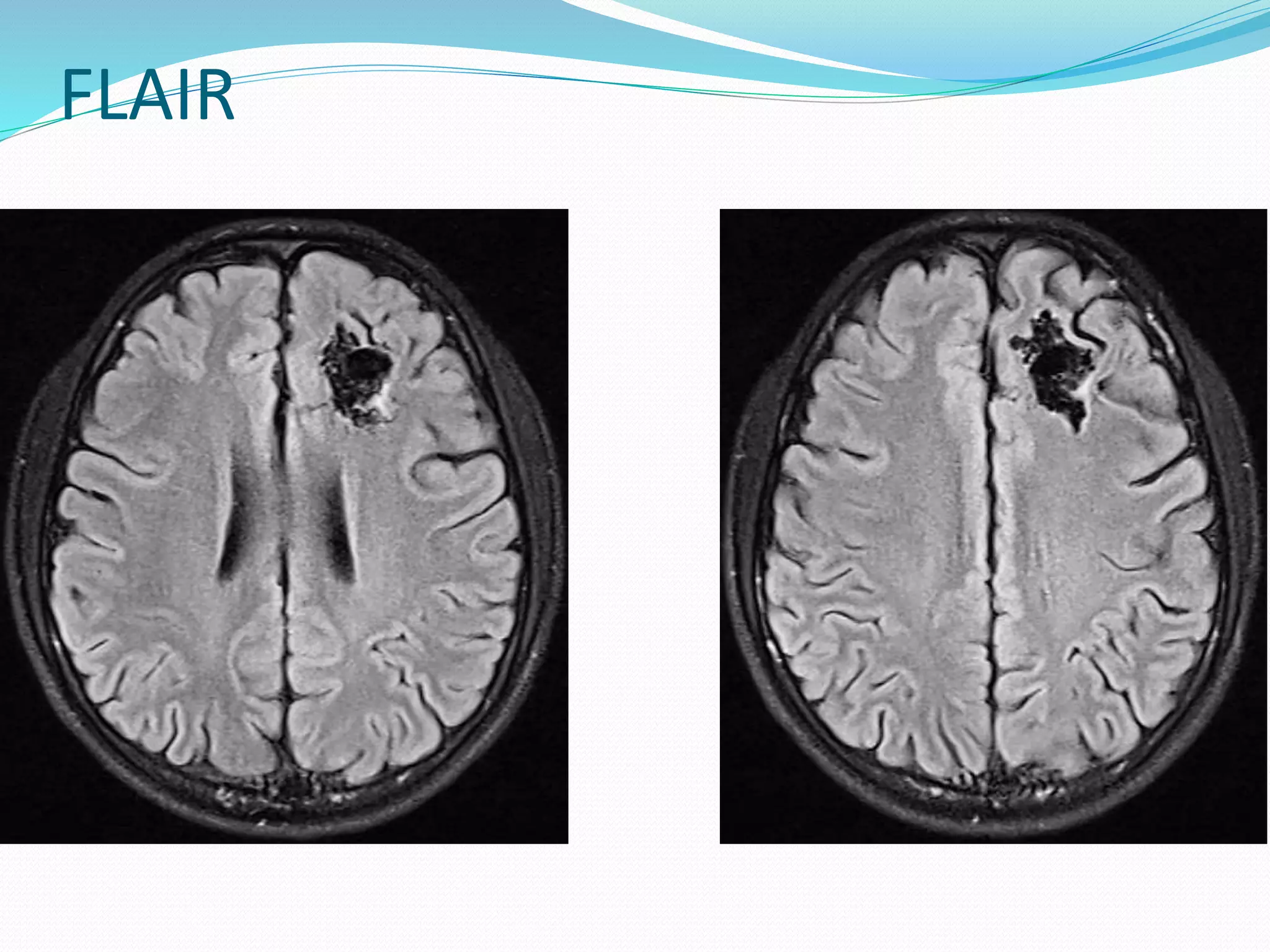 Cerebral/Pial Arteriovenous Malformation (AVM) | PPTX