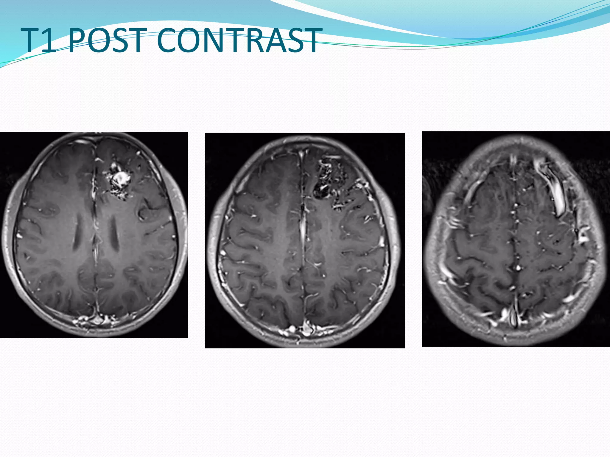 Cerebral/Pial Arteriovenous Malformation (AVM) | PPTX