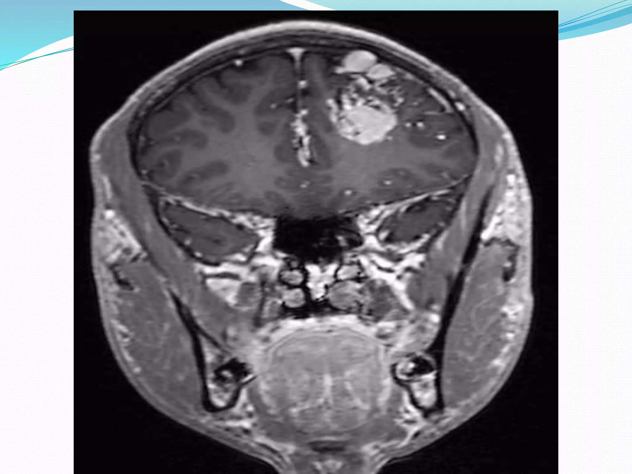Cerebral/Pial Arteriovenous Malformation (AVM) | PPTX