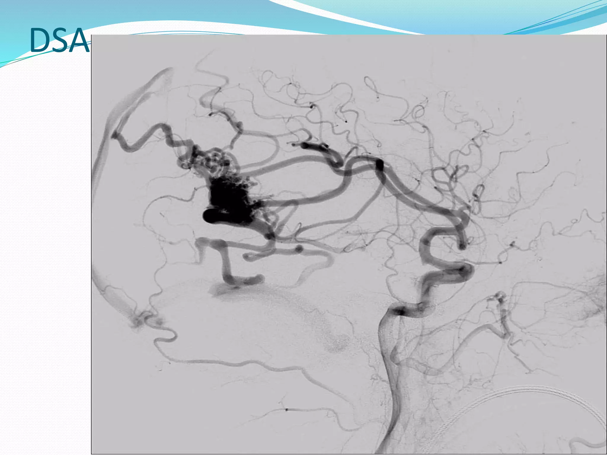 Cerebral/Pial Arteriovenous Malformation (AVM) | PPTX