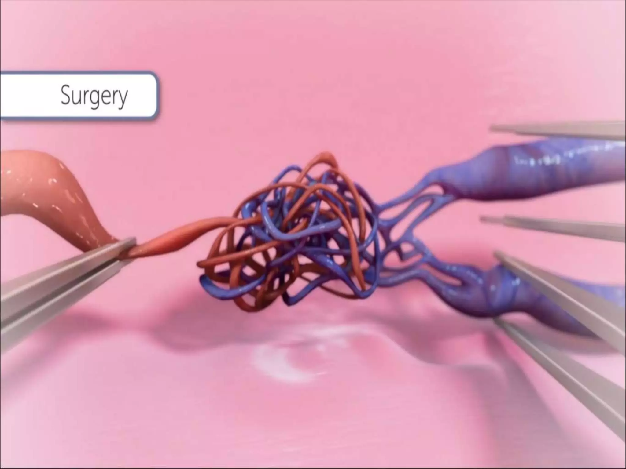 Cerebral/Pial Arteriovenous Malformation (AVM) | PPTX