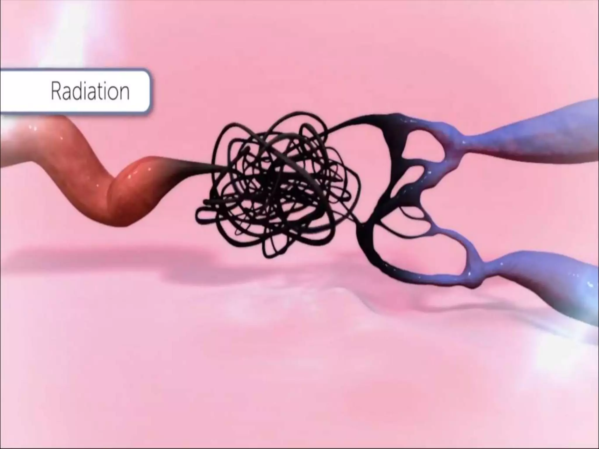 Cerebral/Pial Arteriovenous Malformation (AVM) | PPTX