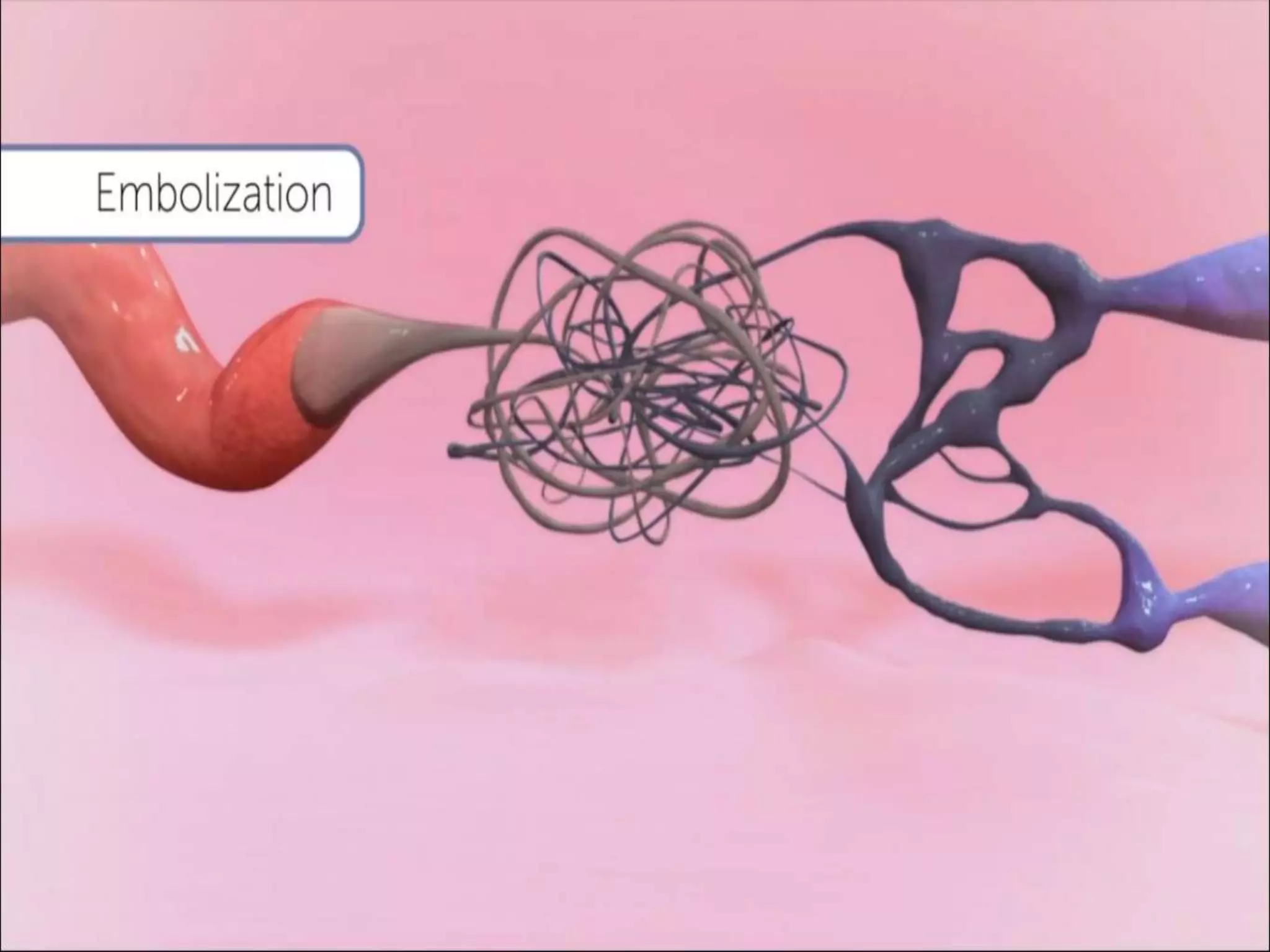 Cerebral/Pial Arteriovenous Malformation (AVM) | PPTX
