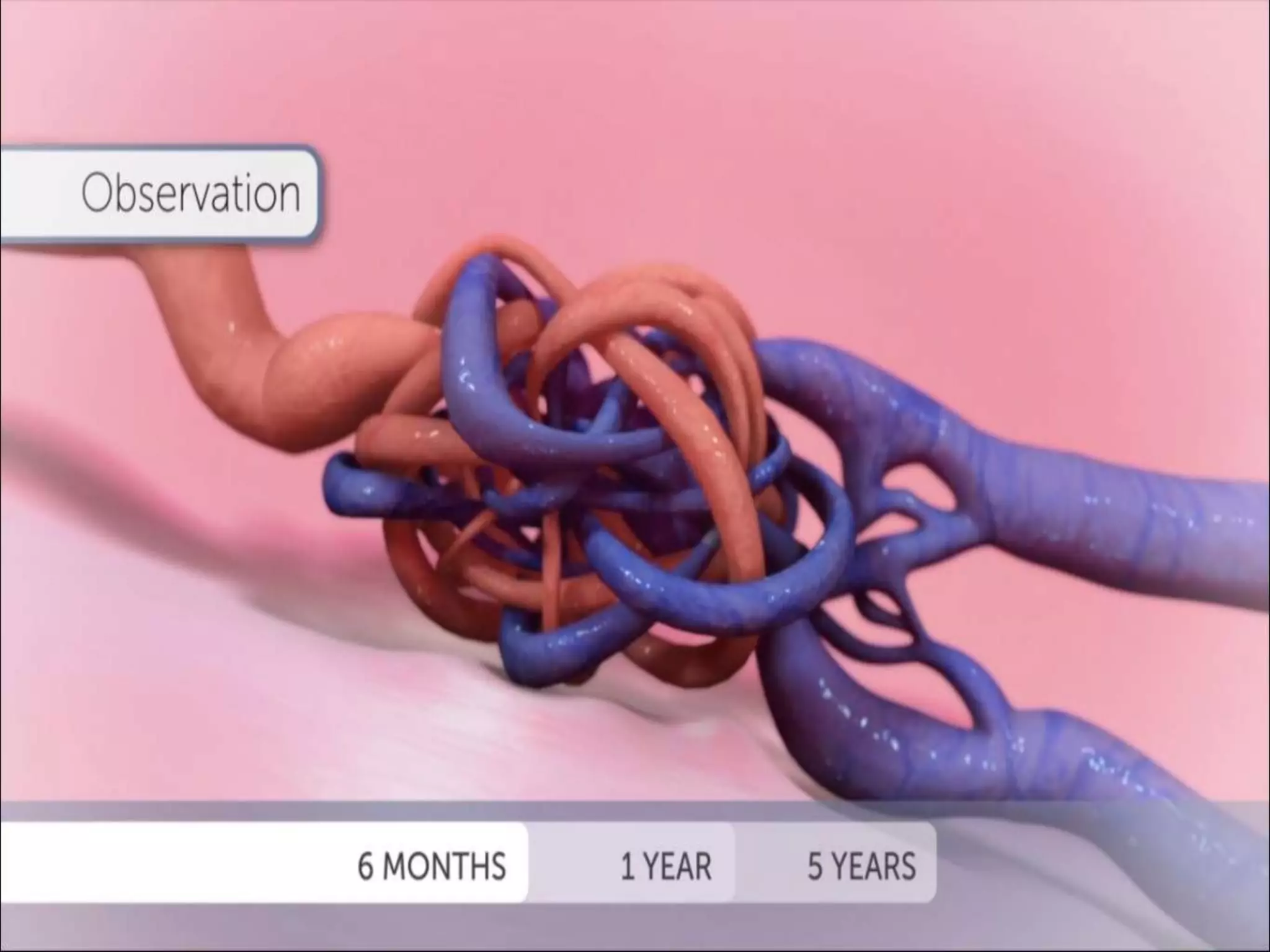 Cerebral/Pial Arteriovenous Malformation (AVM) | PPTX