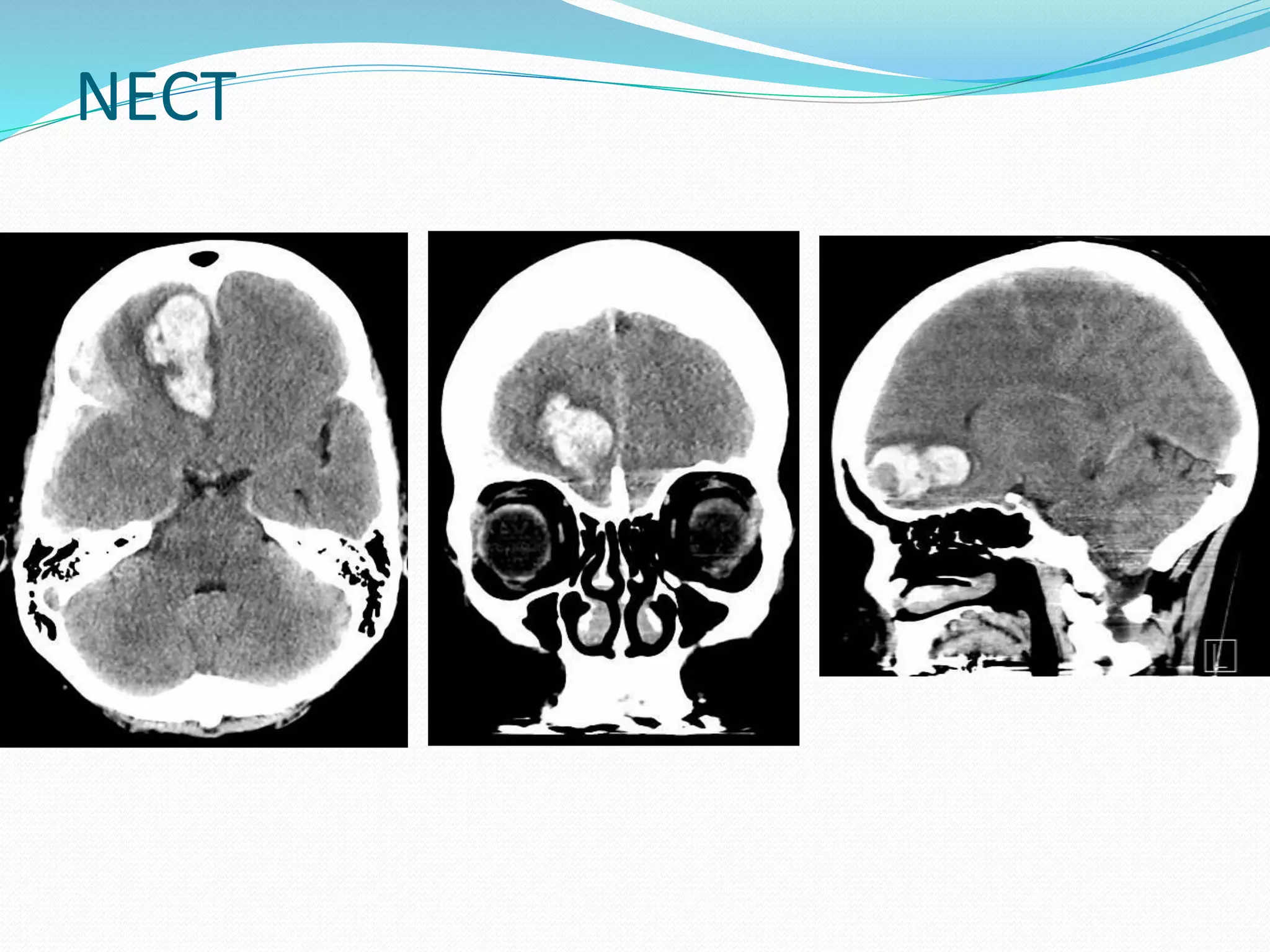 Cerebral/Pial Arteriovenous Malformation (AVM) | PPTX