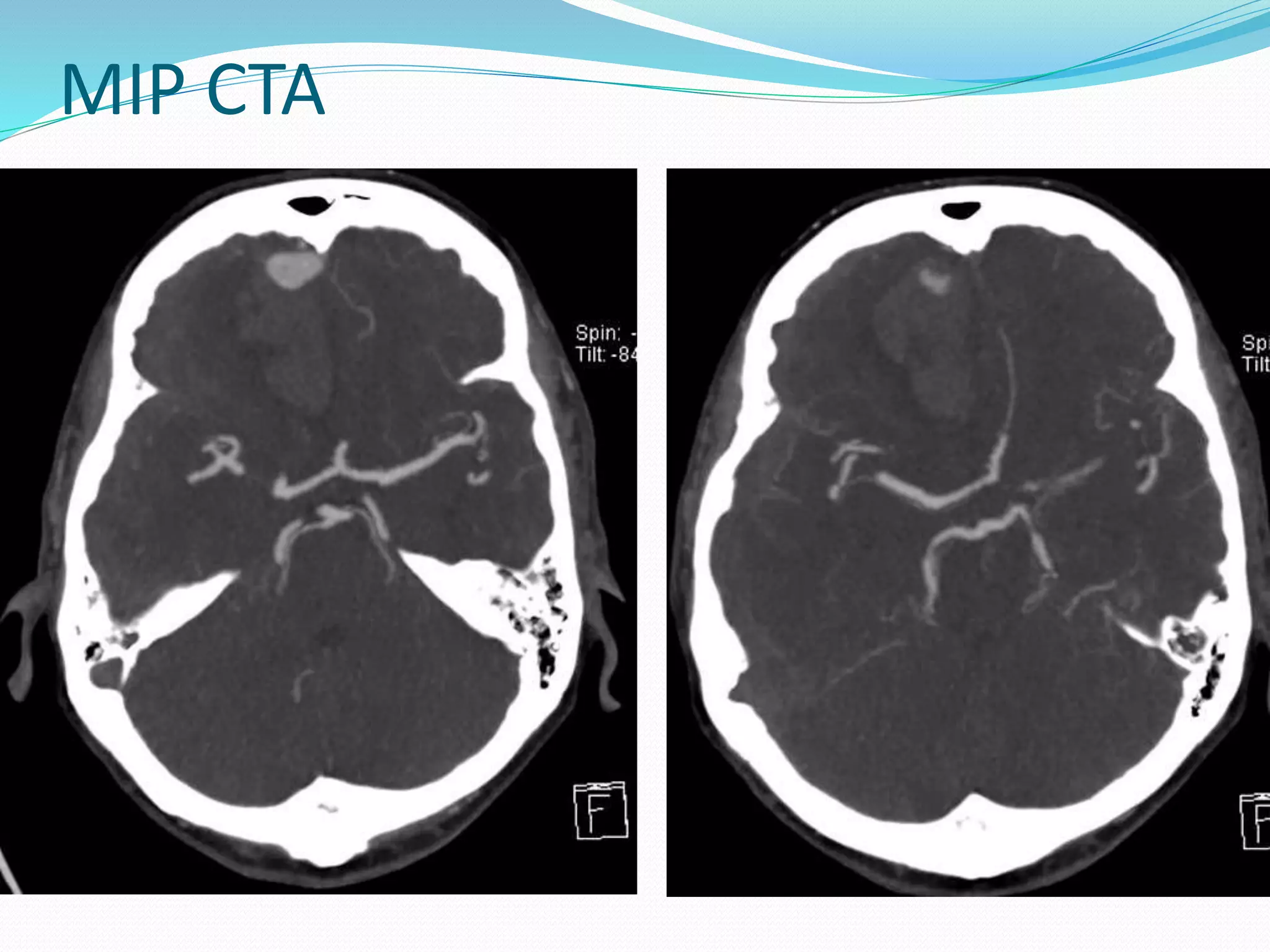 Cerebral/Pial Arteriovenous Malformation (AVM) | PPTX