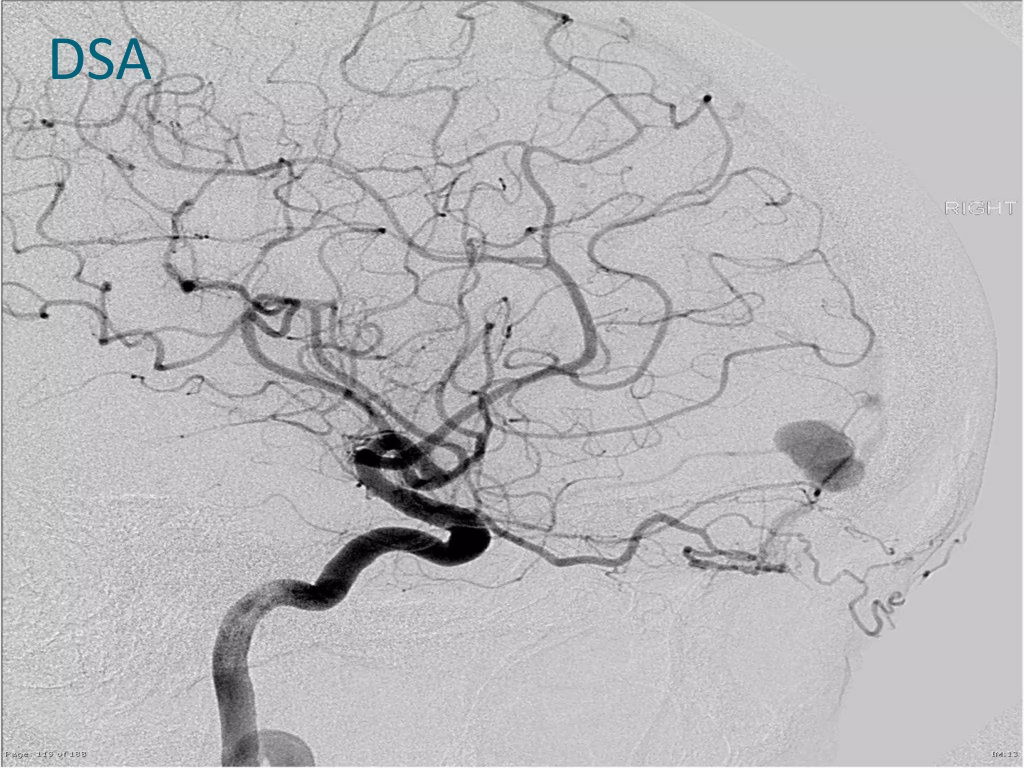 Cerebral/Pial Arteriovenous Malformation (AVM) | PPTX
