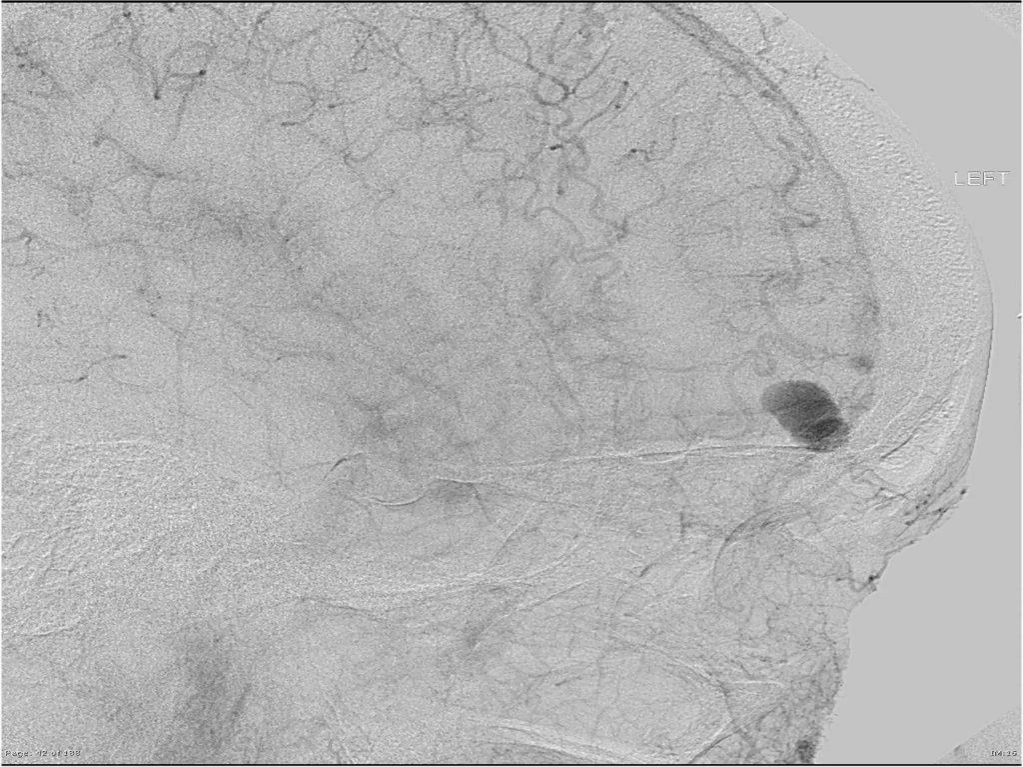 Cerebral/Pial Arteriovenous Malformation (AVM) | PPTX