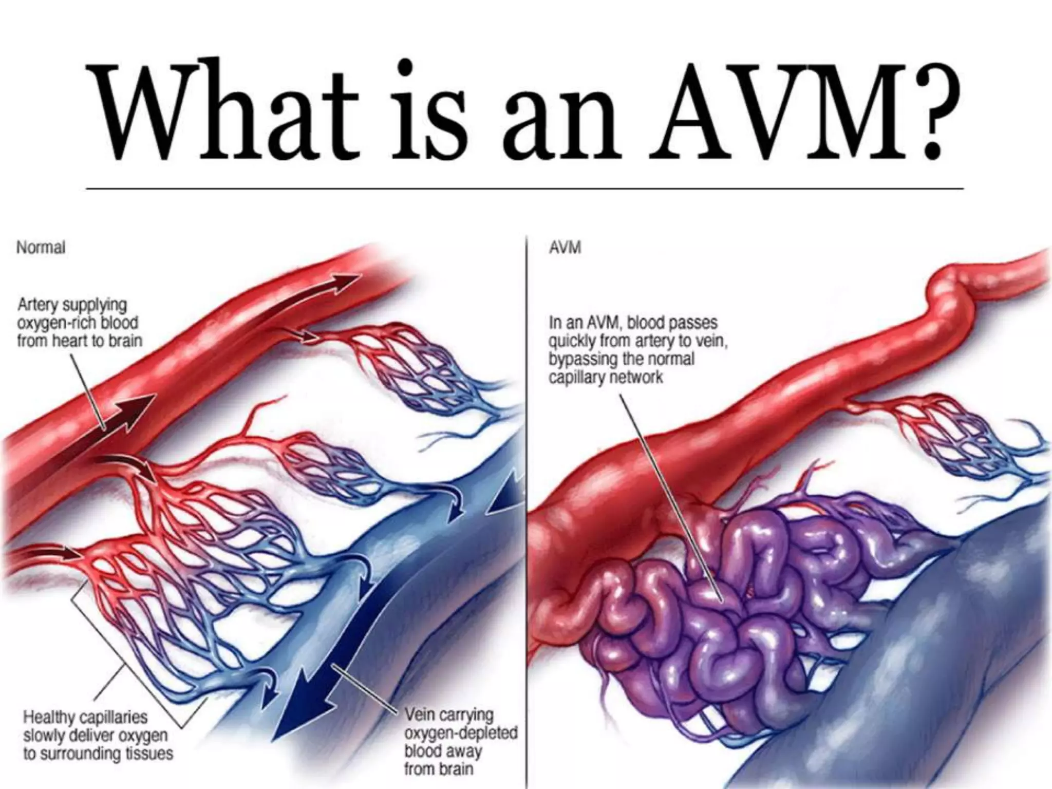 Cerebral/Pial Arteriovenous Malformation (AVM) | PPTX | Brain and ...