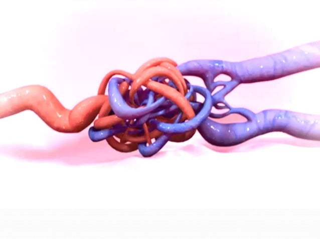 Cerebral/Pial Arteriovenous Malformation (AVM) | PPTX | Brain and ...
