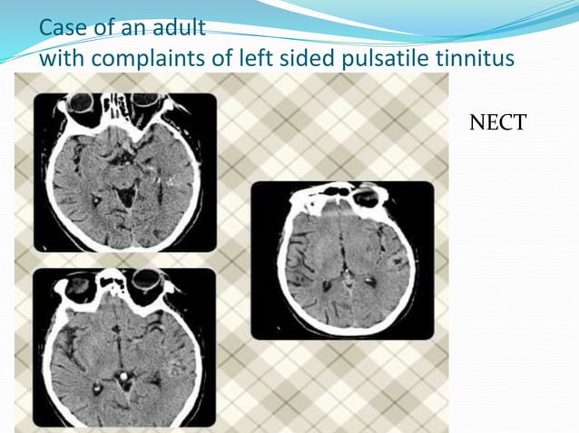 Cerebral/Pial Arteriovenous Malformation (AVM) | PPTX | Brain and ...
