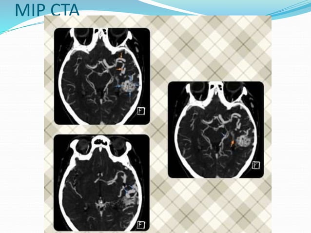 Cerebral/Pial Arteriovenous Malformation (AVM) | PPTX | Brain and ...