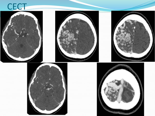 Cerebral/Pial Arteriovenous Malformation (AVM) | PPTX | Brain and ...