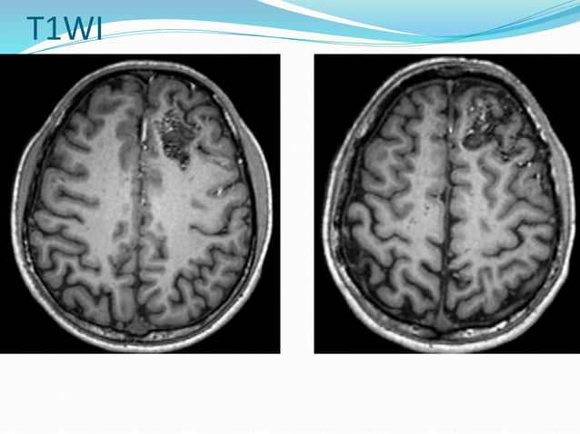 Cerebral/Pial Arteriovenous Malformation (AVM) | PPTX | Brain and ...