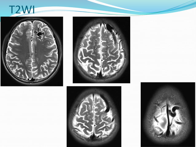 Cerebral/Pial Arteriovenous Malformation (AVM) | PPTX | Brain and ...
