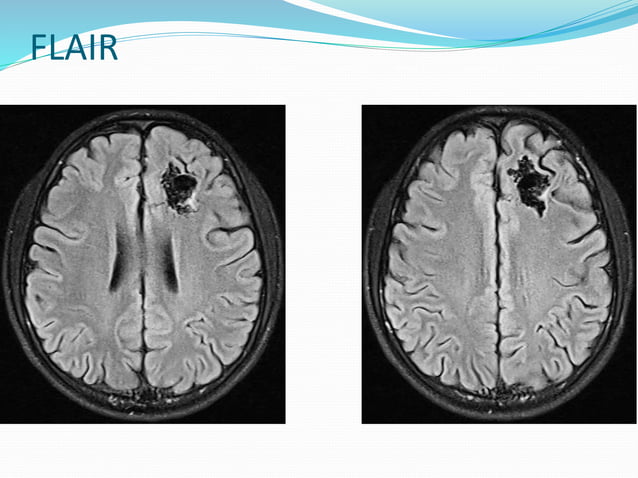 Cerebral/Pial Arteriovenous Malformation (AVM) | PPTX | Brain and ...