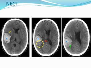 Cerebral/Pial Arteriovenous Malformation (AVM) | PPTX
