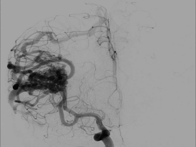 Cerebral/Pial Arteriovenous Malformation (AVM) | PPTX | Brain and ...