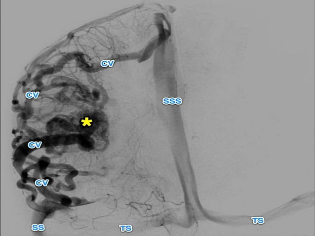 Cerebral/Pial Arteriovenous Malformation (AVM) | PPTX | Brain and ...