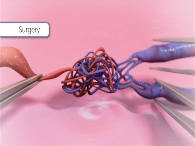 Cerebral/Pial Arteriovenous Malformation (AVM) | PPTX | Brain and ...