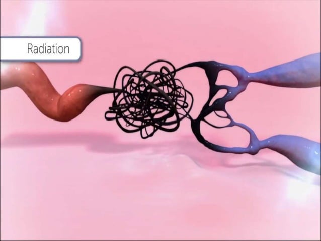 Cerebral/Pial Arteriovenous Malformation (AVM) | PPTX | Brain and ...