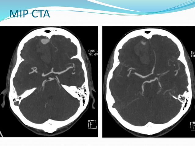 Cerebral/Pial Arteriovenous Malformation (AVM) | PPTX | Brain and ...