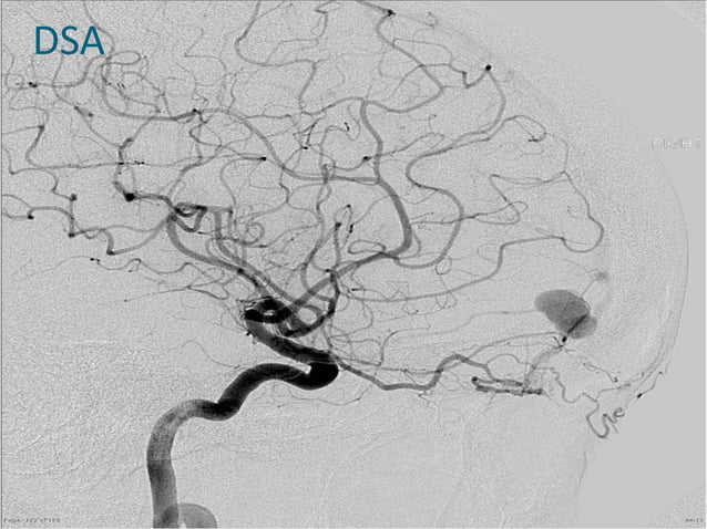 Cerebral/Pial Arteriovenous Malformation (AVM) | PPTX | Brain and ...