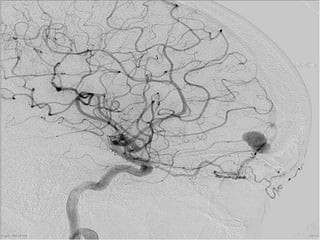 Cerebral/Pial Arteriovenous Malformation (AVM) | PPTX