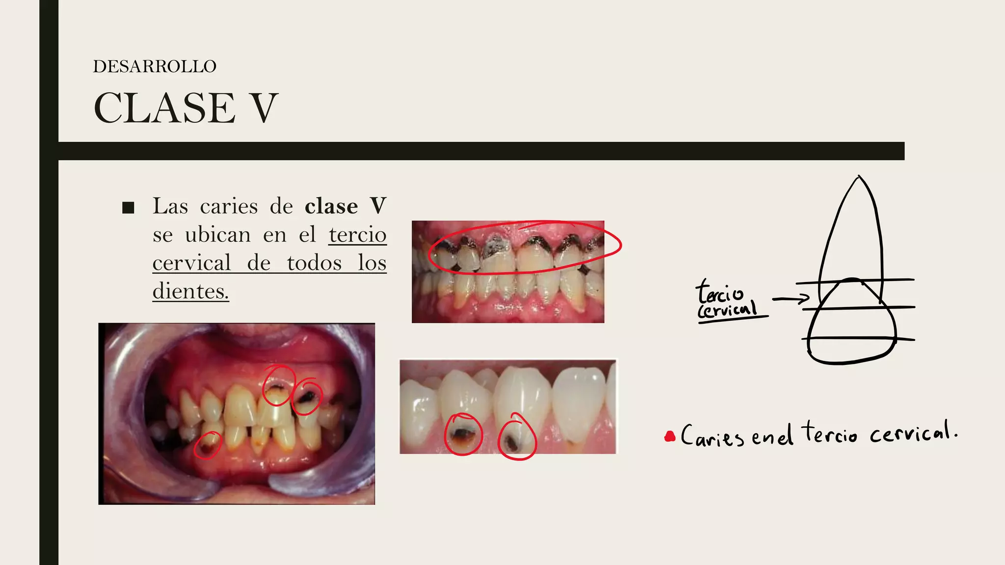 Clasificaciín de Black y Caso clínico | PDF