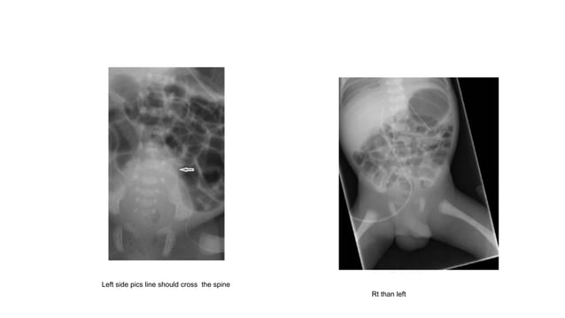 DR RAKESH KOTHA PICC LINE | PPT