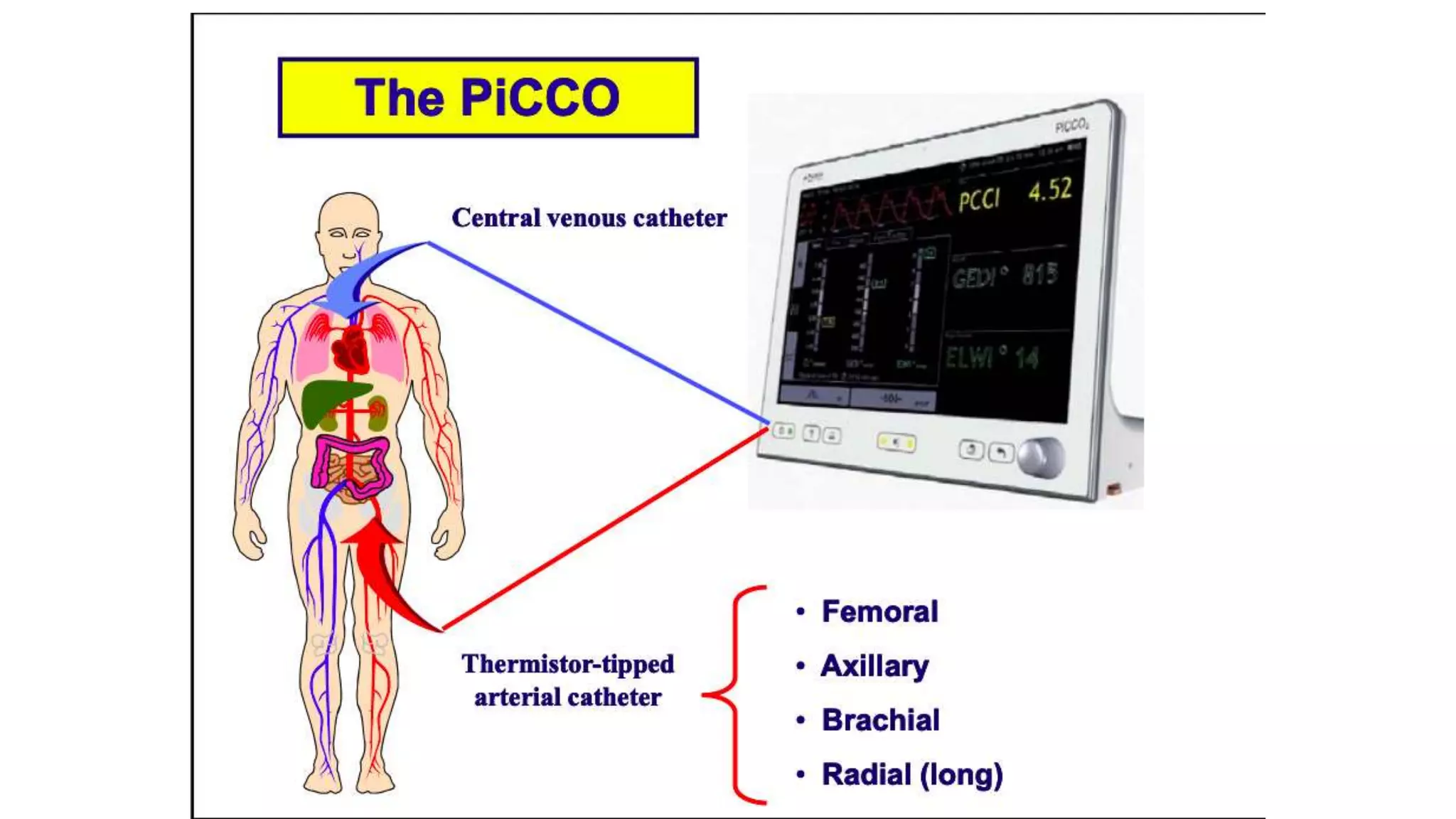 PiCCO Monitor | PPTX