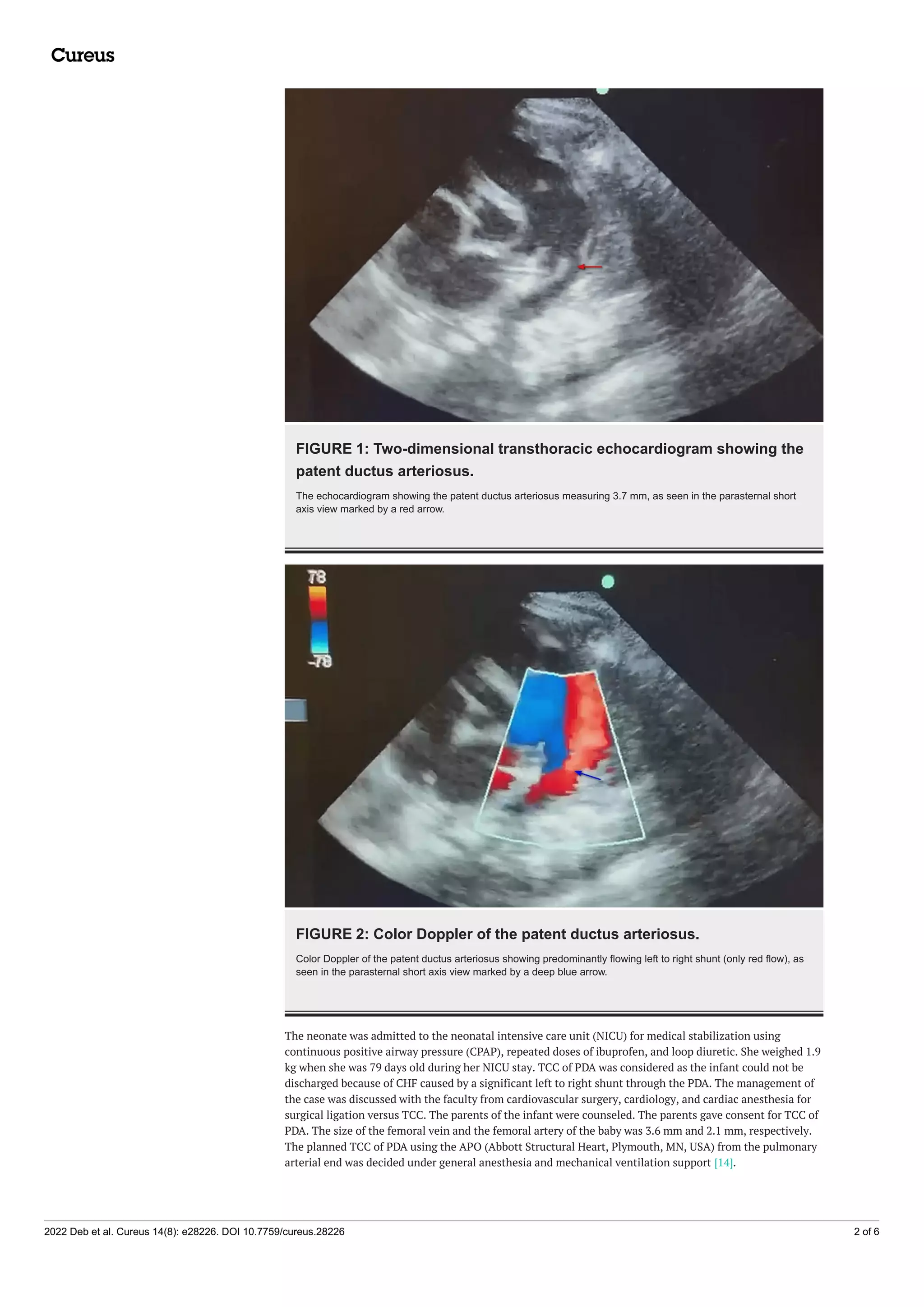 Piccolo Duct Occluder.pdf