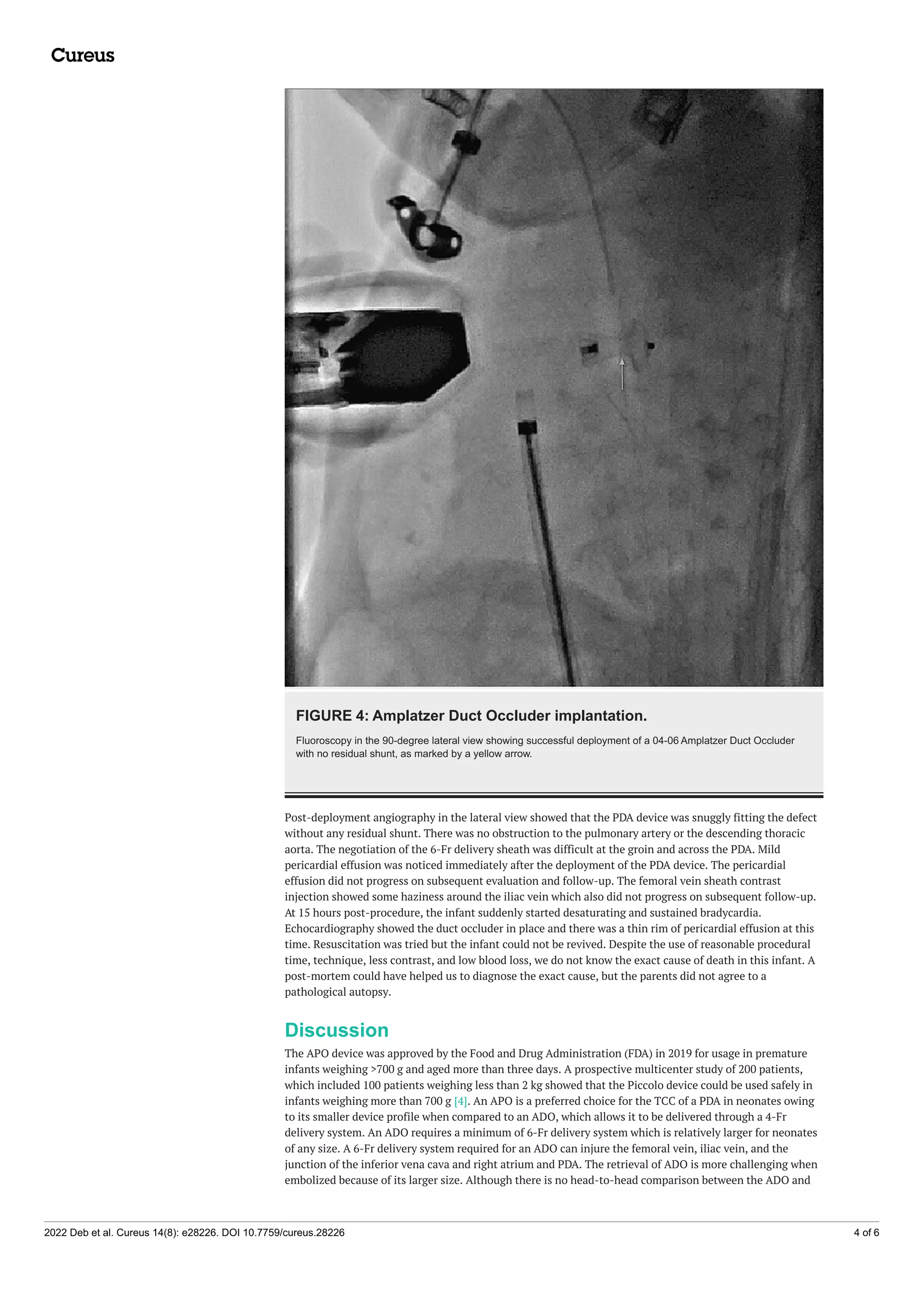 Piccolo Duct Occluder.pdf