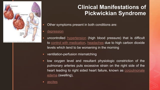 Pickwickian Syndrome Ppt