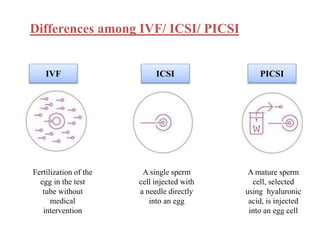 PICSI IVF Physiological intracytoplasmic sperm injection | PPTX