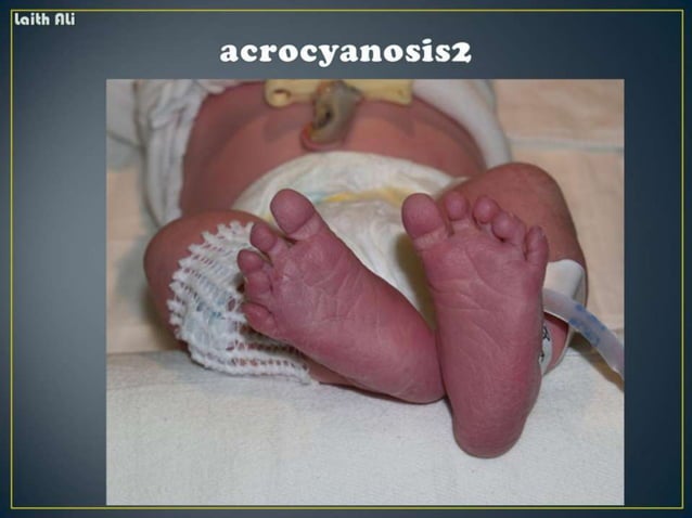 Pictures of pediatric disorders | PPSX | Medical Health