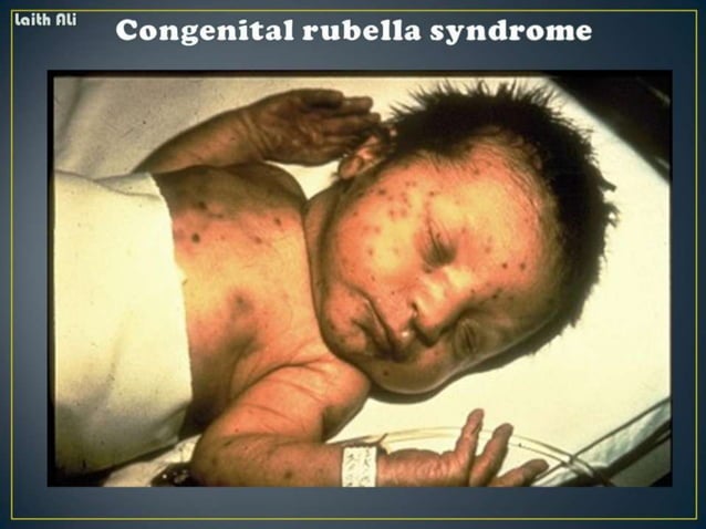 Pictures of pediatric disorders | PPSX | Medical Health
