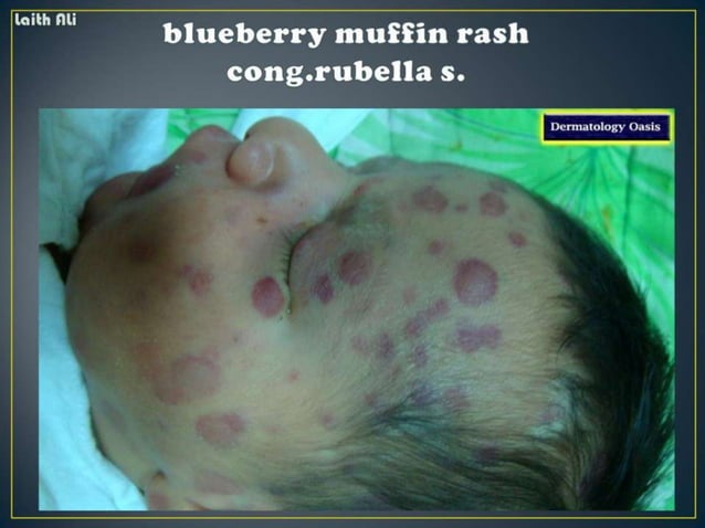 Pictures of pediatric disorders | PPSX | Medical Health