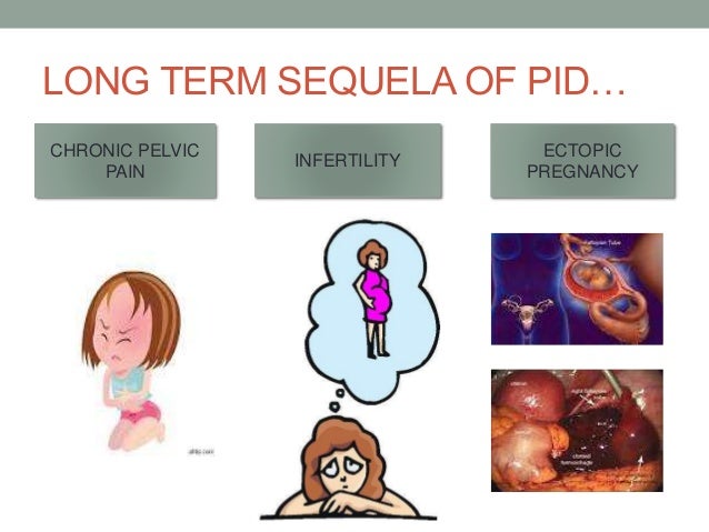 Chronic Pelvic Inflammatory Disease Images