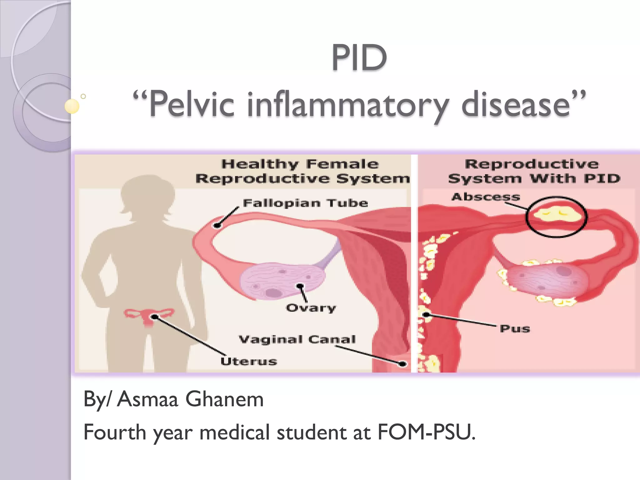 PID "Pelvic Inflammatory Disease" | PDF