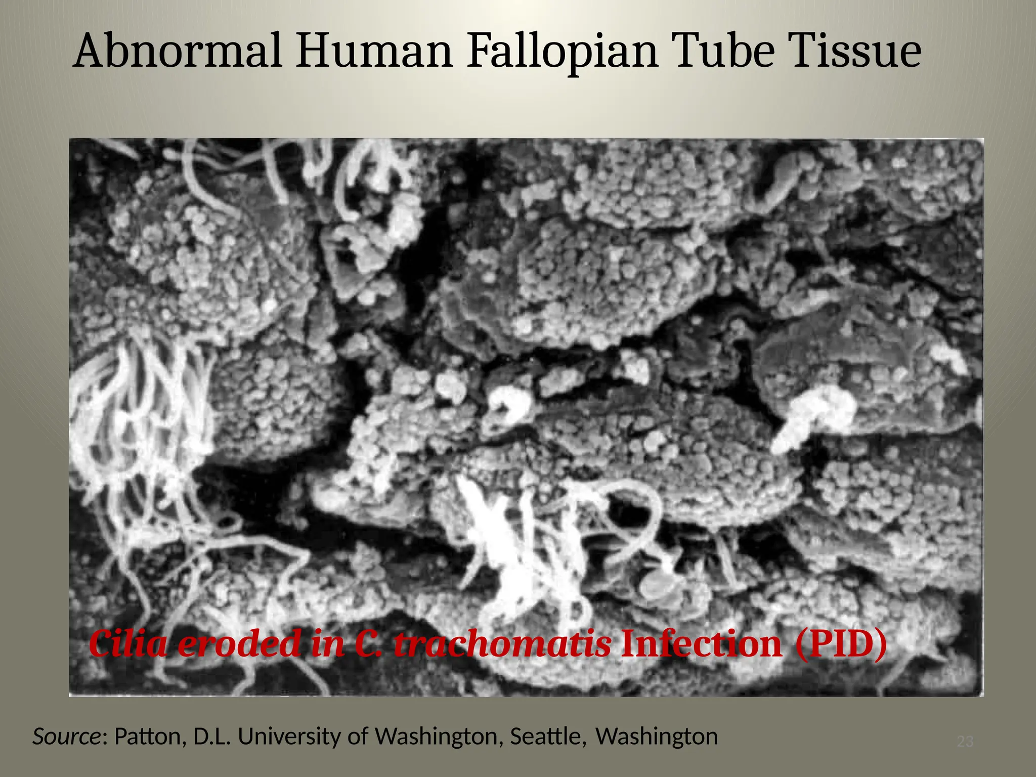 PID.pptx pelvic inflammatory diseases obg | PPTX