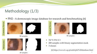 Automatic Skin Lesion Segmentation and Melanoma Detection: Transfer ...