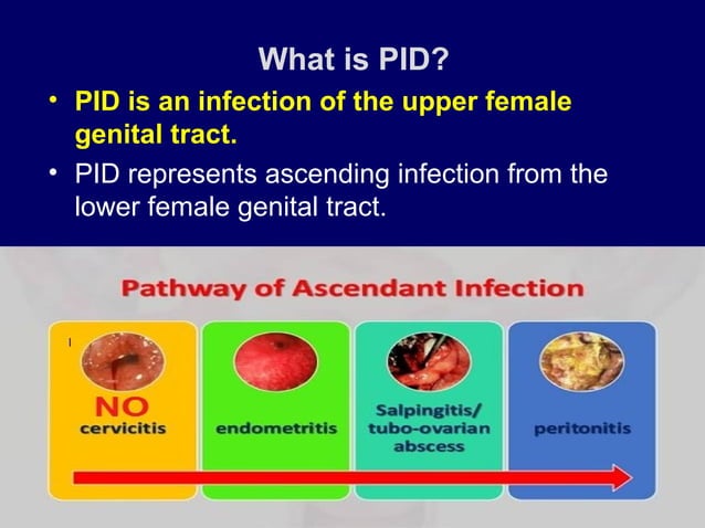 Pelvic Inflammatory Disease (PID) | PPT