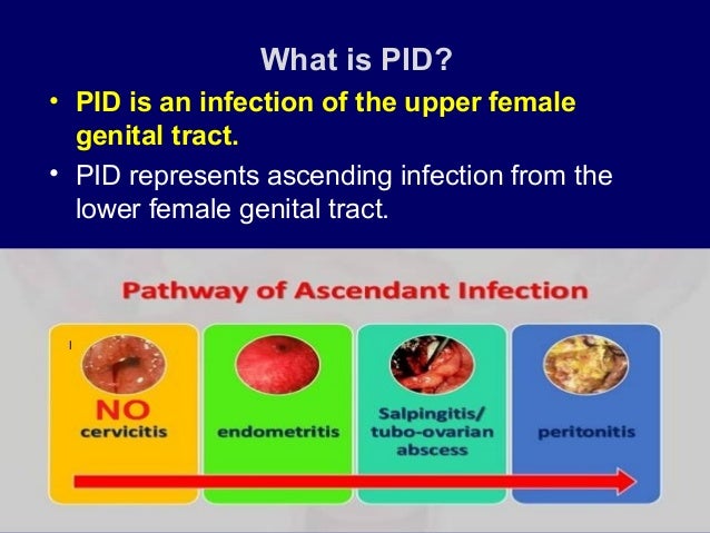 Pelvic Inflammatory Disease (PID)