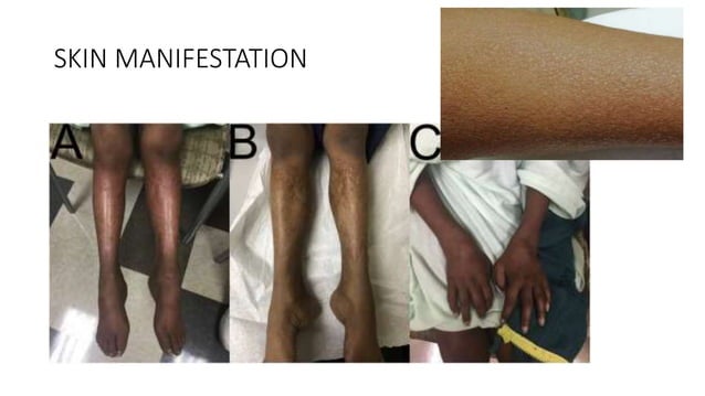 PID case- Blau syndrome final.pptx