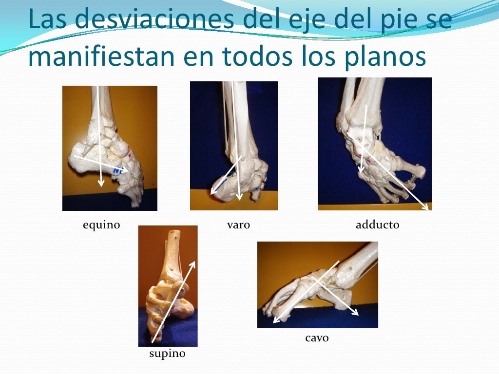 Pie Bot - Información a la Familia