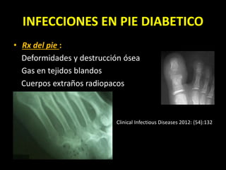 Pie diabetico infectado | PPTX