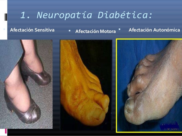 Pie Diabetico en Honduras Dr: Victor Raudales