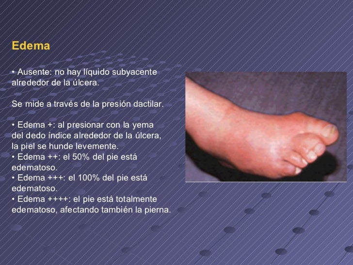 Pie diabético final