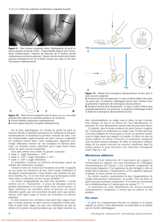 Radiographie Du Pied Bot